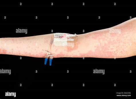 Epstein Barr Virus Infection Close Up Of A Cannula In The Arm Of A 19 Year Old Female Patient