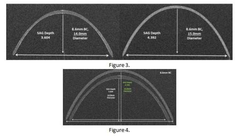 Contact Lens Base Curve Radius