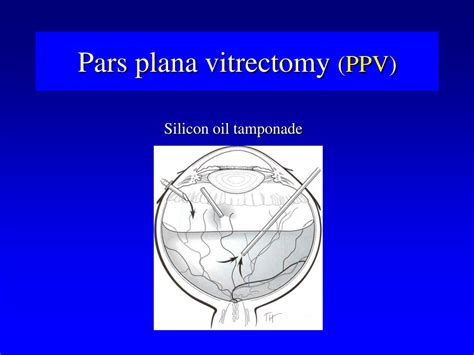 Ppt Vitreoretinal Diseases Diseases Of Vitreous And Retina