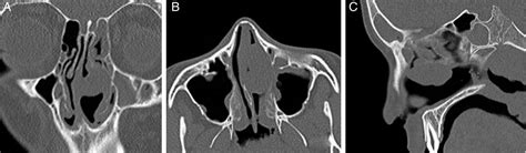 Middle Turbinate Angiofibroma An Unusual Location For Juvenile Angiofibroma Brazilian Journal