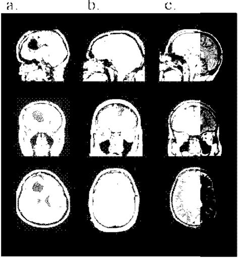 Sagittal Coronal And Axial T1 Weighted MRI Images Of The Anterior Download Scientific Diagram