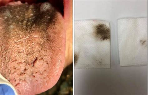 What Do Black Spots On The Tongue Mean