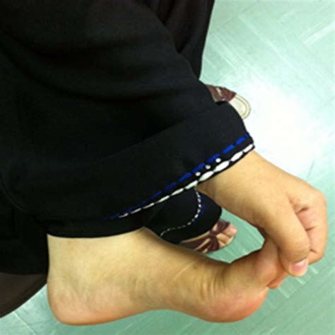 B Measurement Of Popliteal Angle Test Download Scientific Diagram