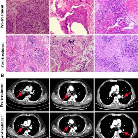 Pathologic A And Radiographic B Response To Neoadjuvant Therapy Of Download Scientific