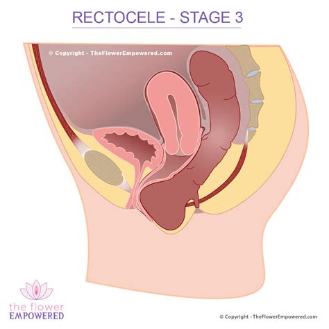 Do Pelvic Floor Exercises Help Rectocele