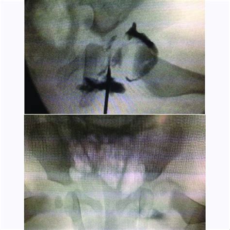 B Left Hip Arthrogram And Closed Reduction Were Performed Under General B Left Hip Arthrogram And Closed Reduction Were Performed Under General