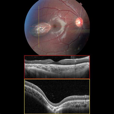 Rwc Retina Rocks On Linkedin Choroidal Coloboma Vs Torpedo Maculopathy