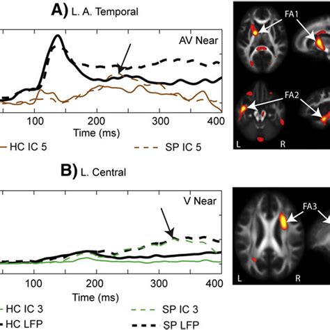 Top Down View Of Magnetoencephalography Meg Planar Gradiometer Sensor Download Scientific