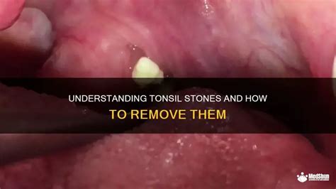 Salivary Stone Vs Tonsil Stone Whats The Difference Xcbubj