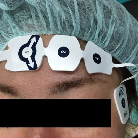 The Bispectral Index Bis Monitor Is An Electroencephalographic Eeg