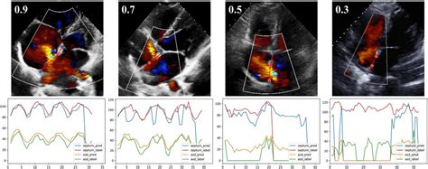 Frontiers Echocardiography Based Ai For Detection And Quantification