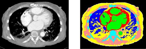 Figure 1 From Nonsmooth Regularization In Electrocardiographic Imaging Semantic Scholar