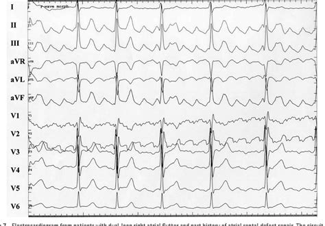 Figure 7 From Prediction Of The Atrial Flutter Circuit Location From The Surface