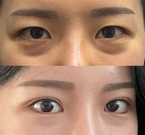 쌍꺼풀 세미아웃라이너트임 리얼후기 눈이 예쁘다그래서 아몬드성형외과