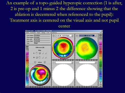 Comparison Of Topography Guided Tgl To Standard Lasik Sl For