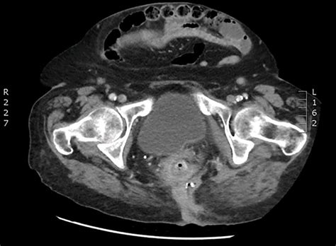 Axial Plane Ct Demonstrating The Infected Mesh Download Scientific Diagram