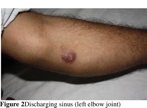 Figure 1 From Scrofuloderma A Common Type Of Cutaneous Tuberculosis A