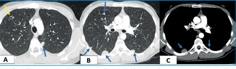 Figure 2 From A Rare Malignancy Mimicker Echinococcus Alveolaris