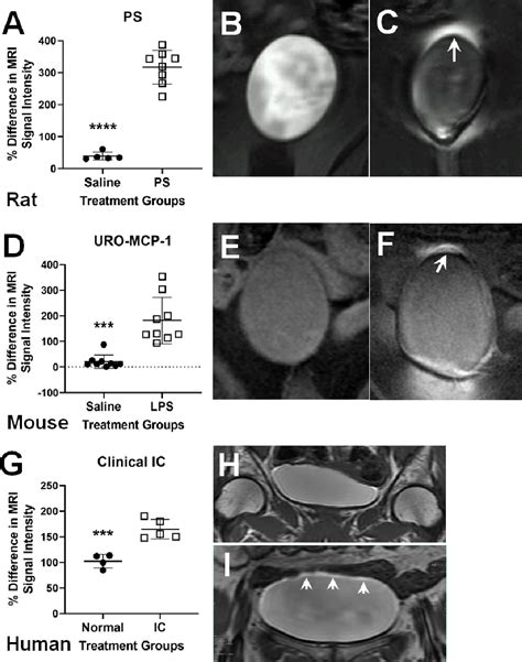 Figure 1 From Mri As A Tool To Assess Interstitial Cystitis Associated Bladder And Brain