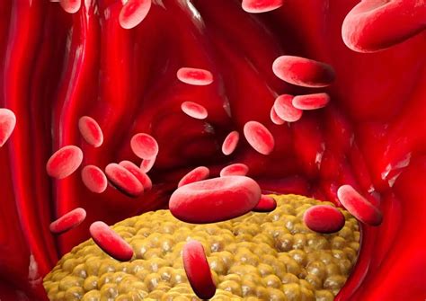 Worried About High Triglycerides High Triglyceride Study