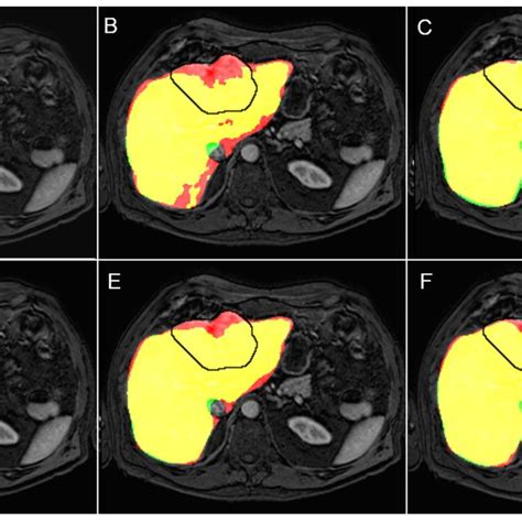 Two Examples Of The Late Arterial Phase Of The Dce Mri Scans The Download Scientific Diagram
