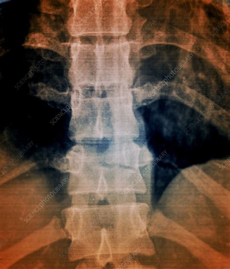 Thoracic Spine Fracture X Ray Stock Image C Science Photo Library