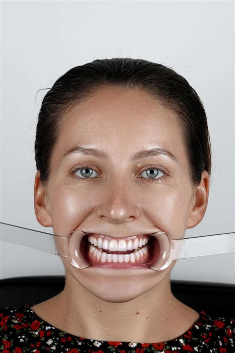 E Max виниры могут выглядеть совершенно естественно Нашей пациентке хотелось вернуть цвет зубов