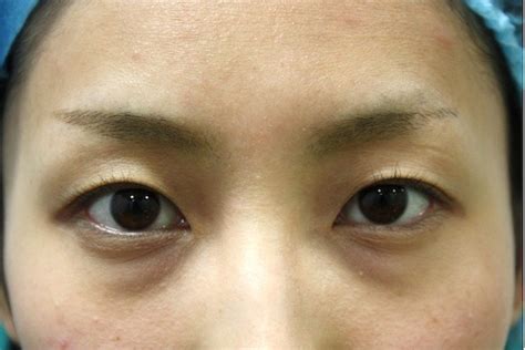 东京美容医院非常受欢迎的不易脱落的双眼皮手术埋线微切法 东京整形美容医院 青山赛俪丝医院东京千叶中文官网