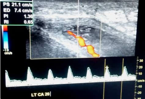 B Figures 3a And 3b Triplex Doppler Waveforms Of The Right And Left Download Scientific Diagram