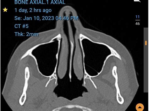How Enlarged Are These Turbinates Having Trouble Finding Comparison Scans R Sinusitis