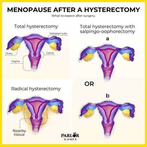 Post Hysterectomy Hrt Hormone Replacement Therapy Menopause Gcznu