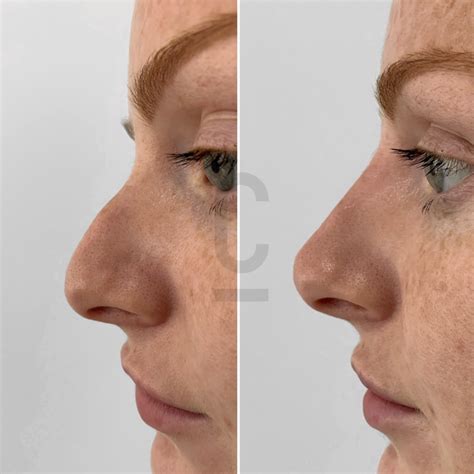 Nose Reshaping With Dermal Fillers Cosmetic Connection