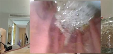 China Girl S Stomach Endoscope Thisvid Com