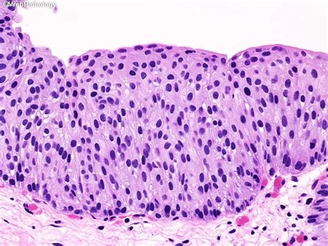 Urothelial Dysplasia