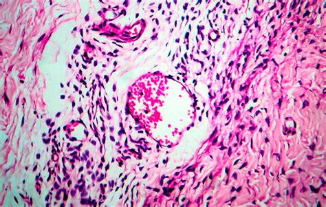 Arquivo De Cisto ósseo Dr Davi Bellan