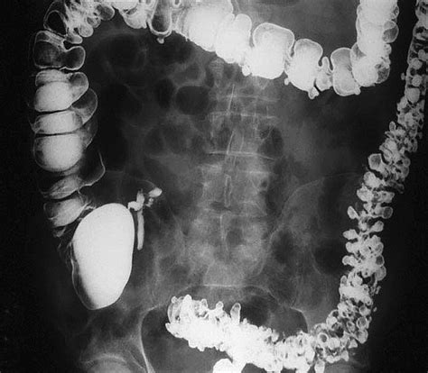 Diverticulitis X Ray