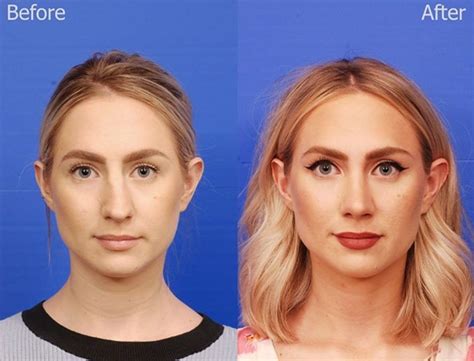Rhinoplasty — Sky Facial Plastic Surgery