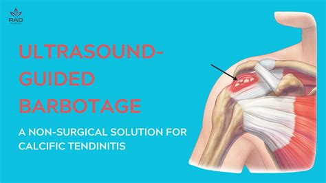 Ultrasound Guided Barbotage For Calcific Tendinitis Rad Clinics