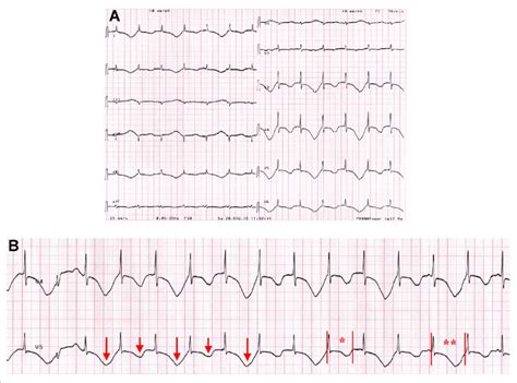 Ecg Findings On Patient 3 On Admission A B T Wave Alternans With Download Scientific