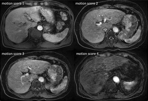 Ranking Of Motion Artifacts In Mr Imaging On A 4 Point Scale Axial