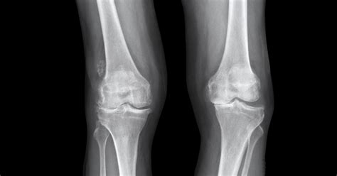 Do Not Overlook Knee Crepitus It Can Be Treated Bangkok