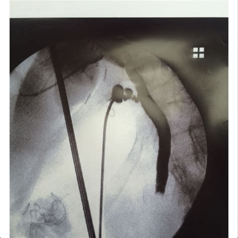 Intraoperative Cholangiogram Showing A Filling Defect That Prevents