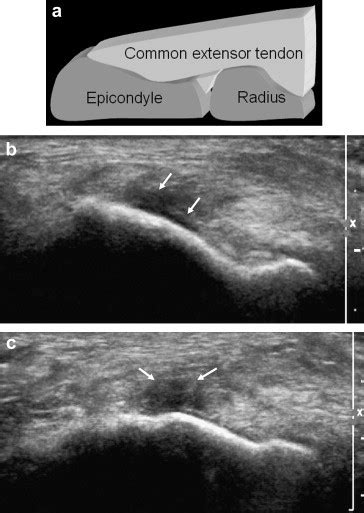 Acute Partial Rupture Of The Common Extensor Tendon Pmc