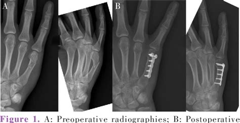 Figure 1 From Functional Results Of Osteosynthesis With Mini Plate And Screws In Metacarpal