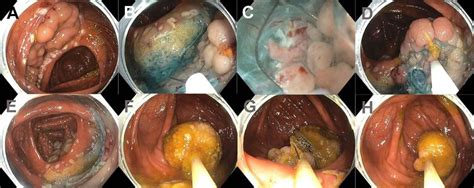 Polypectomy For Large Polyps With Endoscopic Mucosal Resection