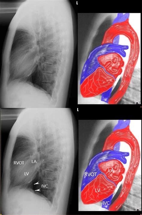 Left Atrium Size The Common Vein
