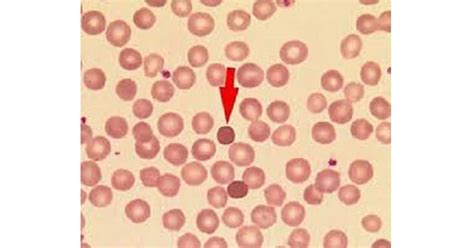 Splenectomy Archives