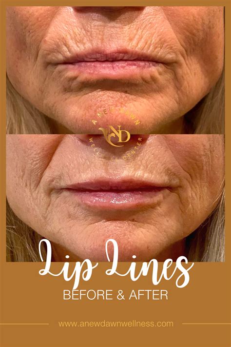 Lip Lines Before And After Fillers On Lips Before And After Lip