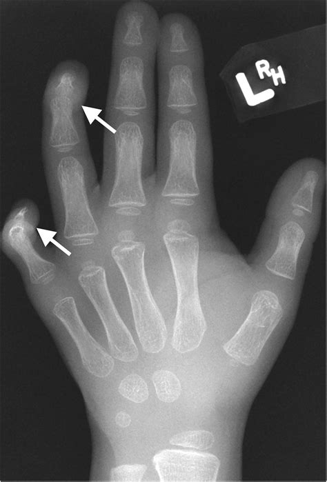Linear Scleroderma Manifested By Hyperpigmentation And Skin Tightening