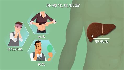 科普认识肝硬化：肝硬化早期的 蛛丝”马迹！腾讯视频